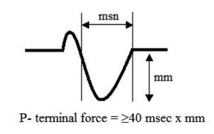 P波とは？ | 心電図.com