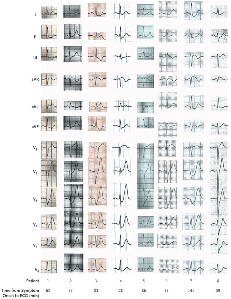 de Winter ST/T wave complexとは？ | 心電図.com