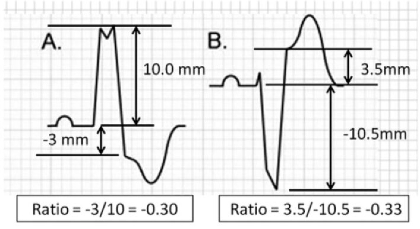 Smith’s Criteriaとは？ | 心電図.com