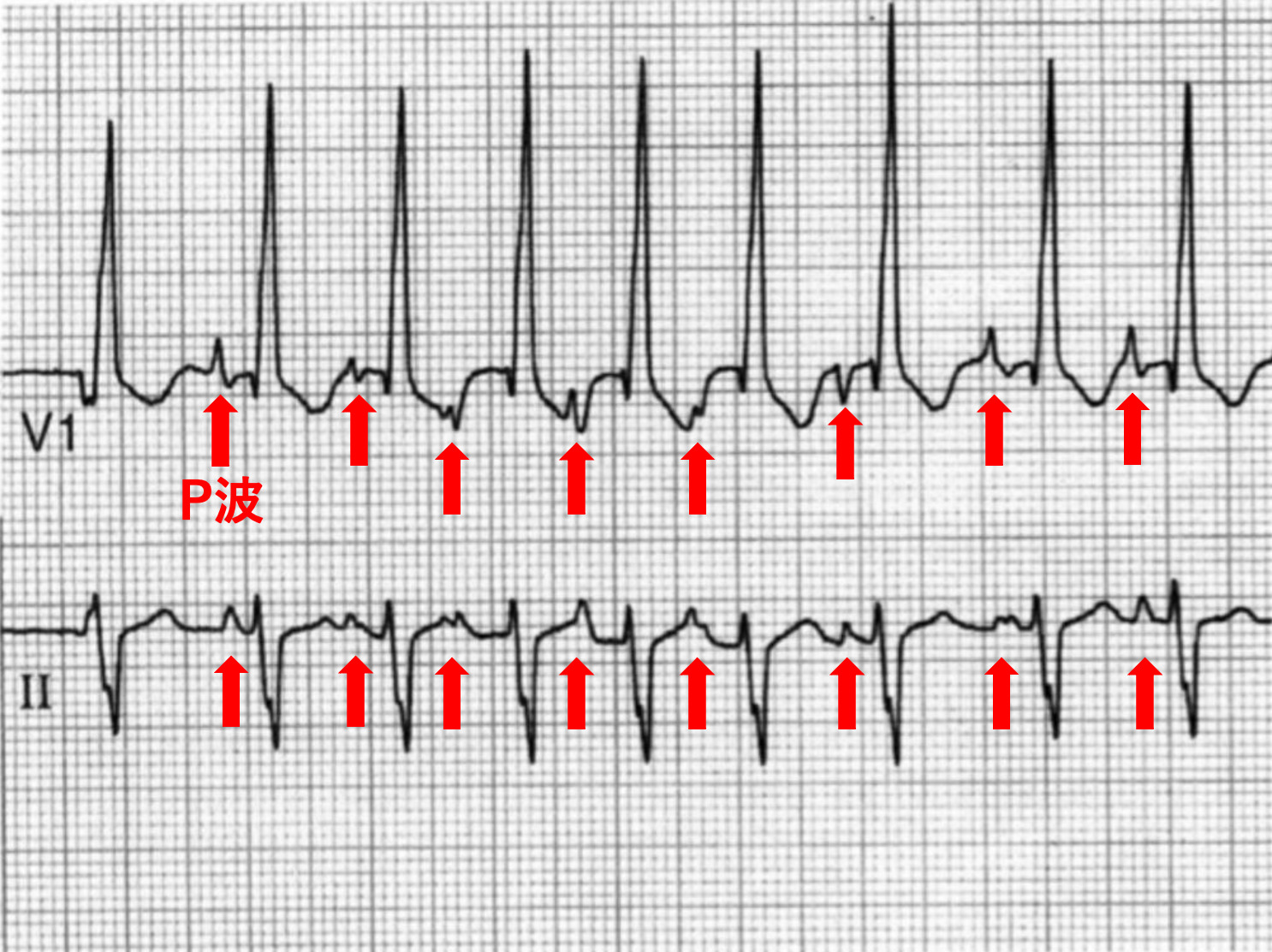 洞性頻脈とは？ | 心電図.com