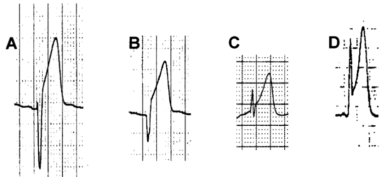 de Winter ST/T wave complexとは？ | 心電図.com