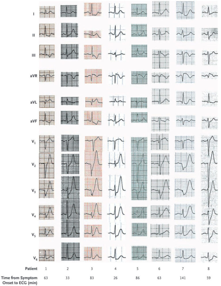 de Winter ST/T wave complexとは？ | 心電図.com