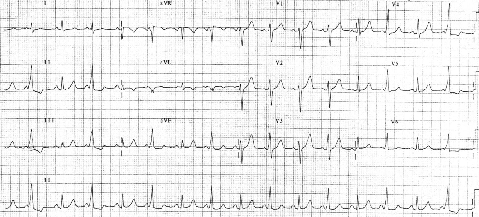 Electrical alternansとは？ | 心電図.com
