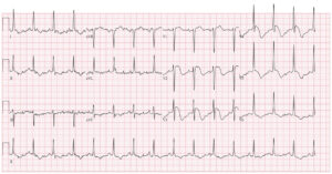 spiked-helmet signとは？ | 心電図.com