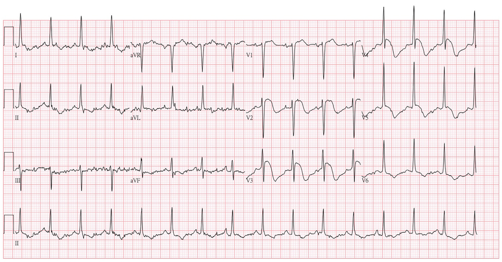 spiked-helmet signとは？ | 心電図.com