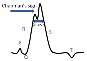 Chapman’s signとは？ | 心電図.com