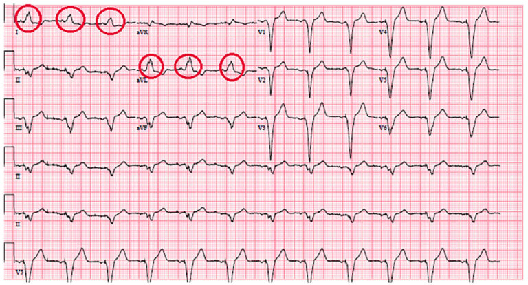 Chapman’s signとは？ | 心電図.com