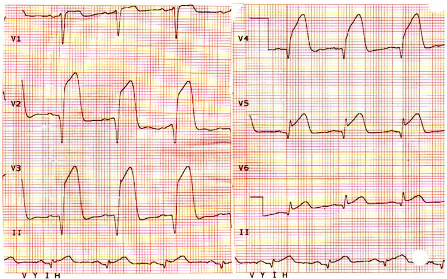Tombstoningとは？ | 心電図.com
