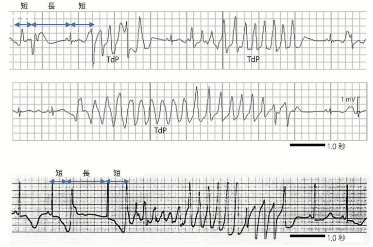 short-long-short sequenceとは？ | 心電図.com