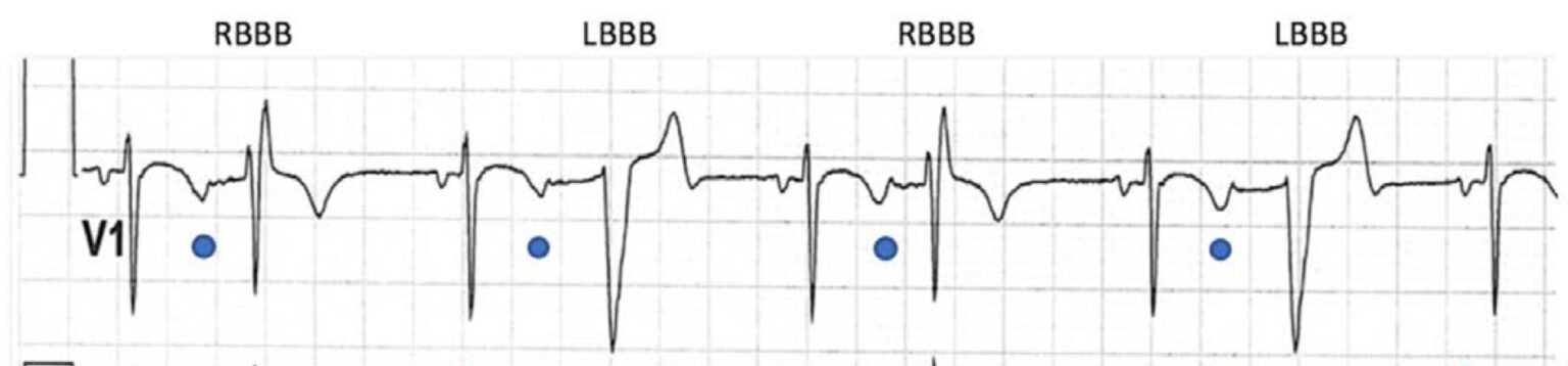 交代性脚ブロックとは？ | 心電図.com