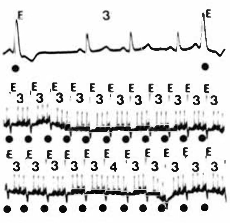 四段脈とは？ | 心電図.com