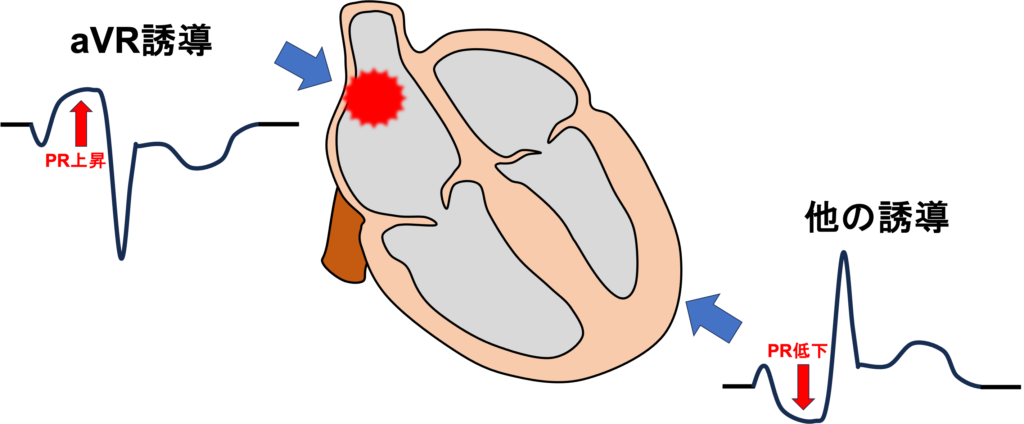 急性心膜炎とは？ | 心電図.com