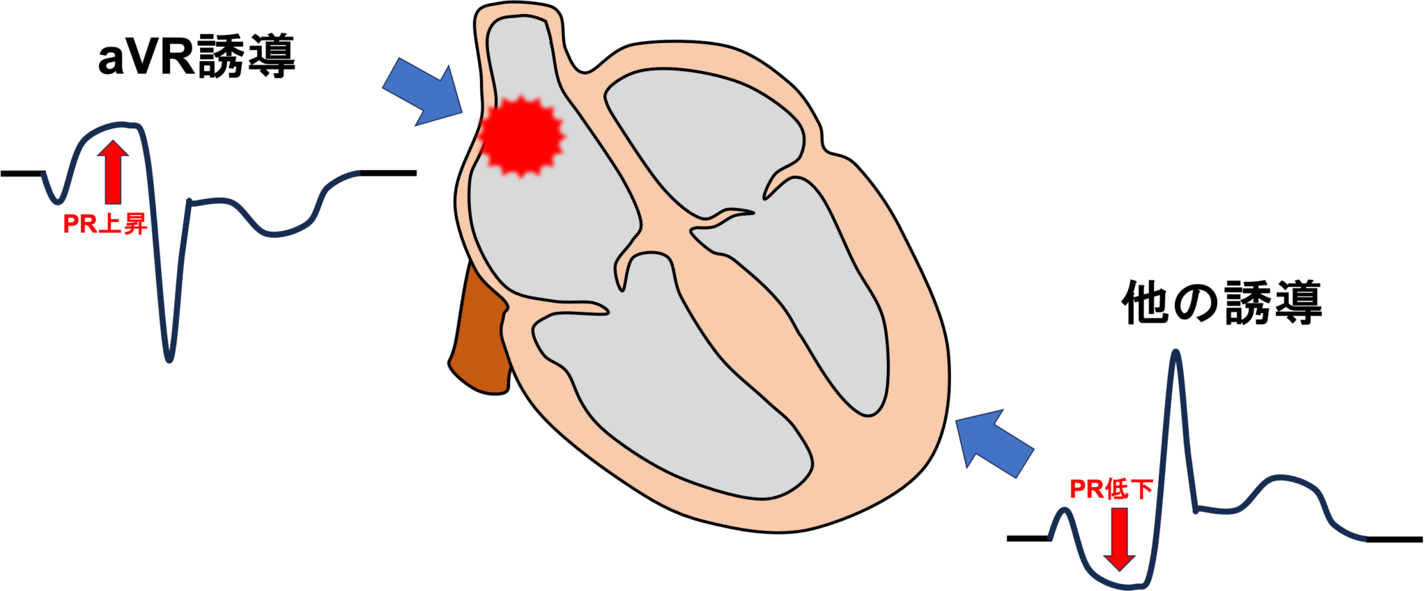 急性心膜炎とは？ | 心電図.com