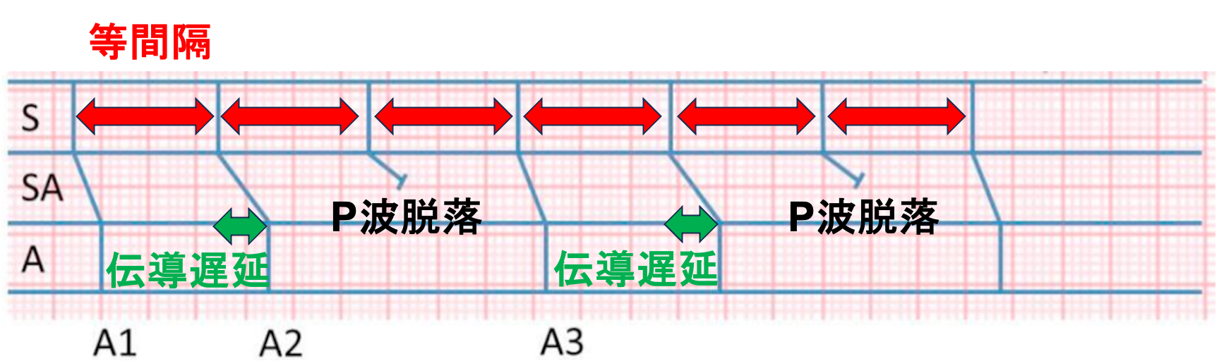 Wenckebach型Ⅱ度洞房ブロックとは？ | 心電図.com