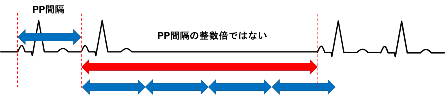 洞停止とは？ | 心電図.com