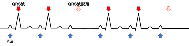 MobitzⅡ型Ⅱ度房室ブロックとは？ 心電図com