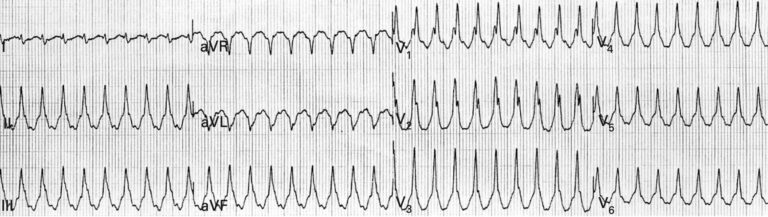 房室回帰性頻拍(AVRT)とは？ | 心電図.com