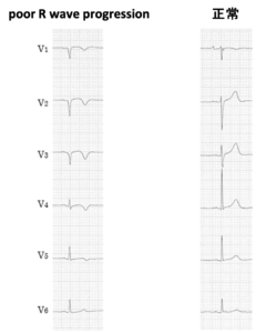 poor R wave progressionとは？ | 心電図.com