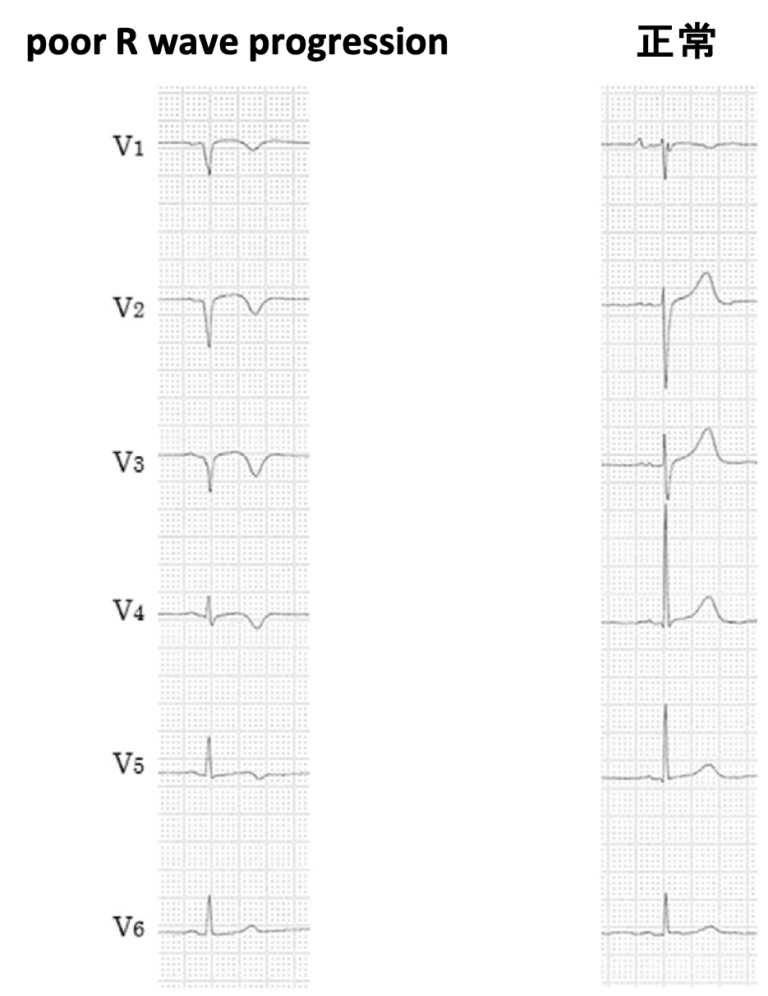 poor R wave progressionとは？ | 心電図.com