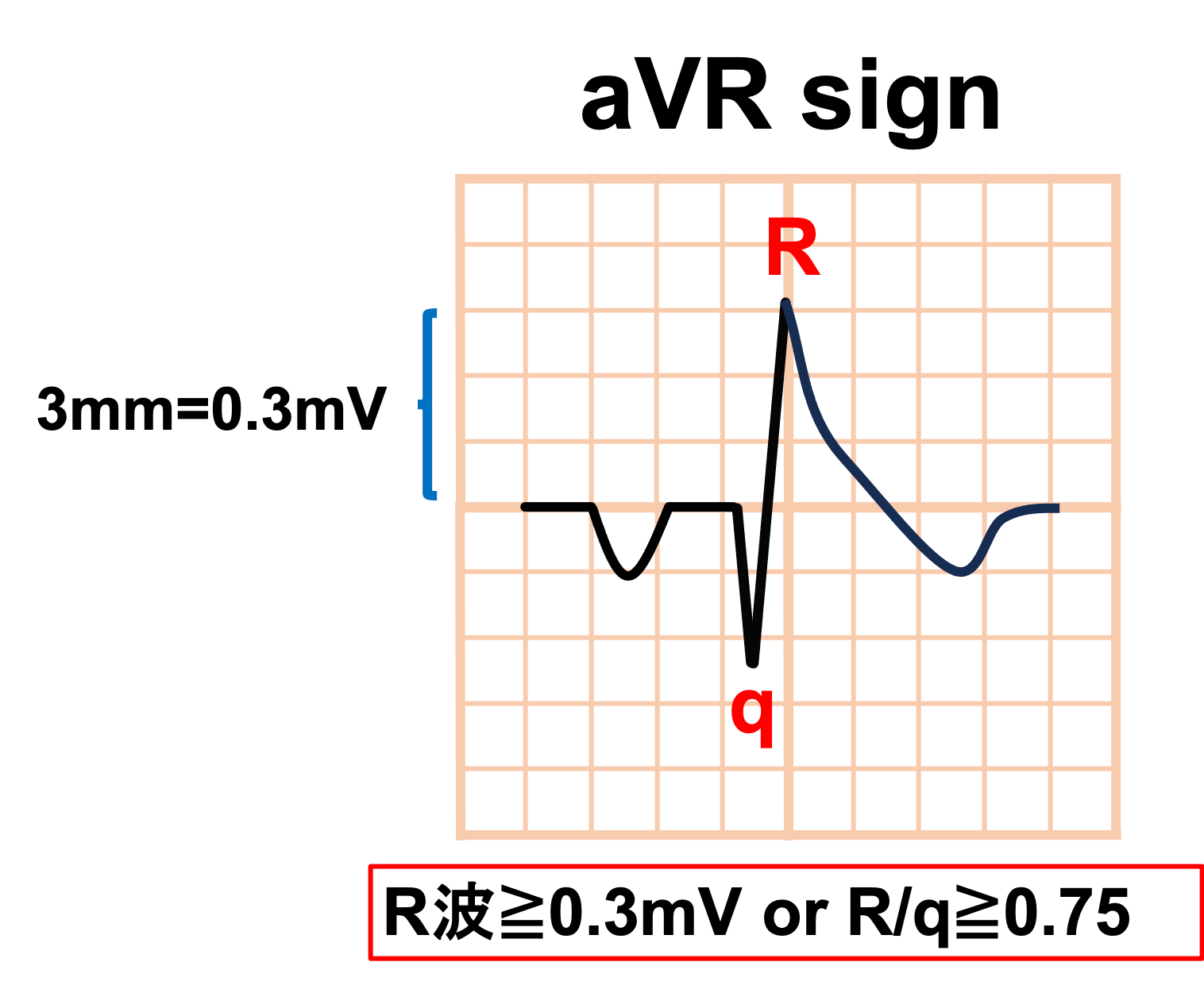 aVR signとは？ | 心電図.com