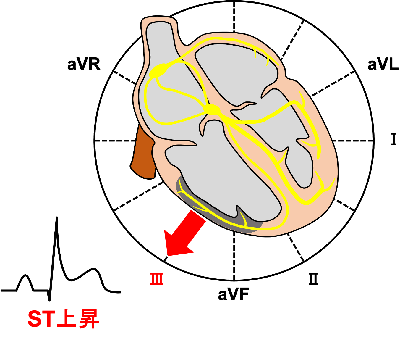 Aslanger’s patternとは？ | 心電図.com
