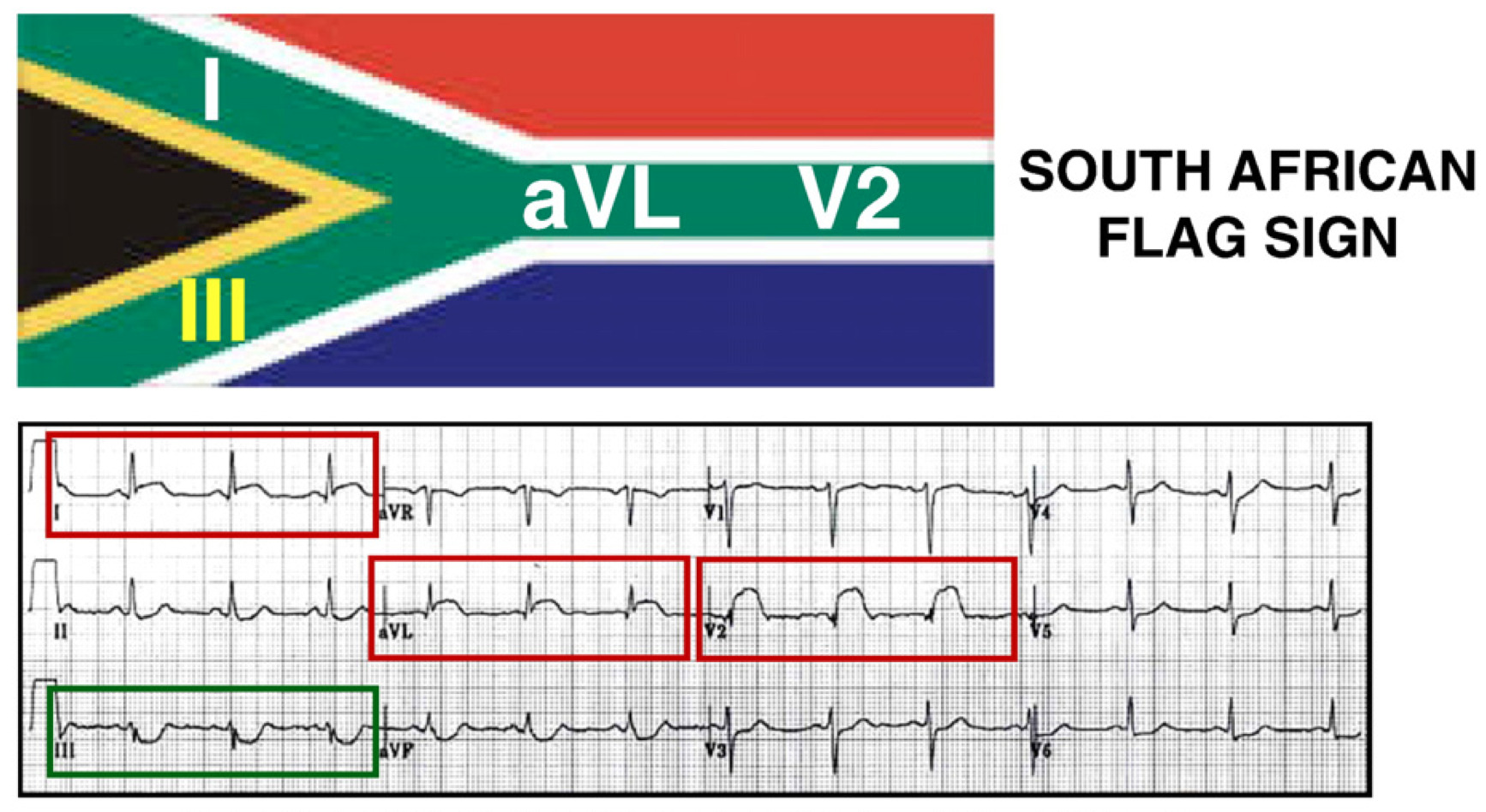 South African flag signとは？ | 心電図.com