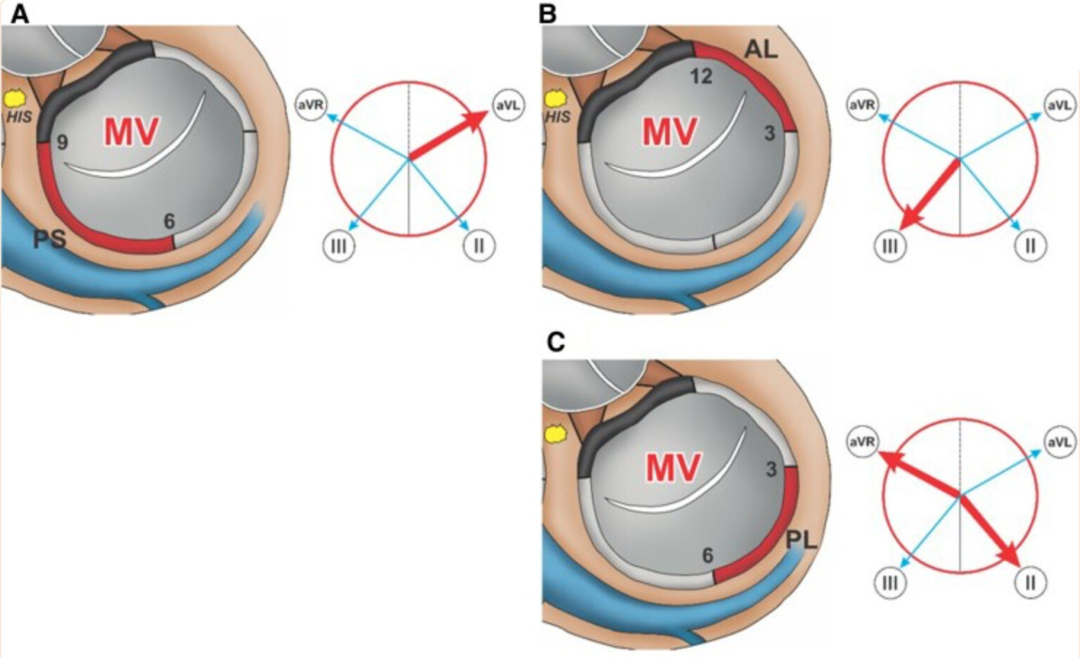 EASY-WPWとは? | 心電図.com
