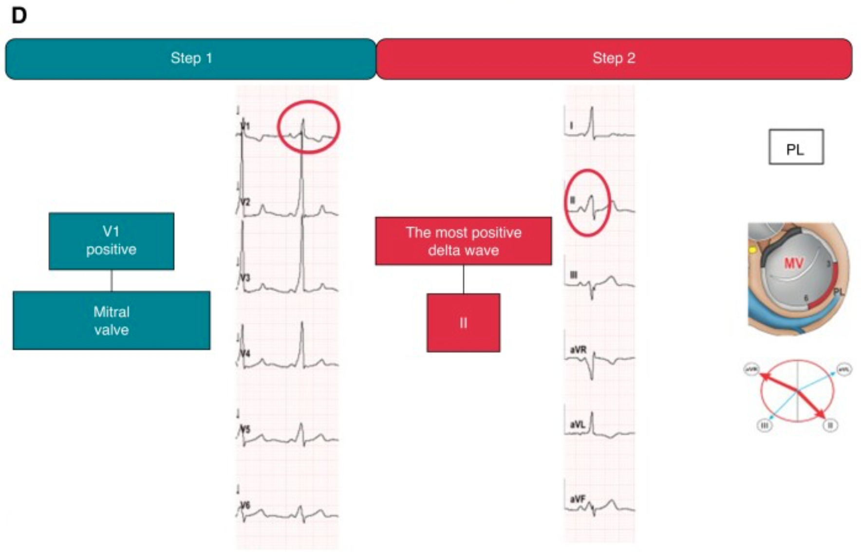 EASY-WPWとは? | 心電図.com
