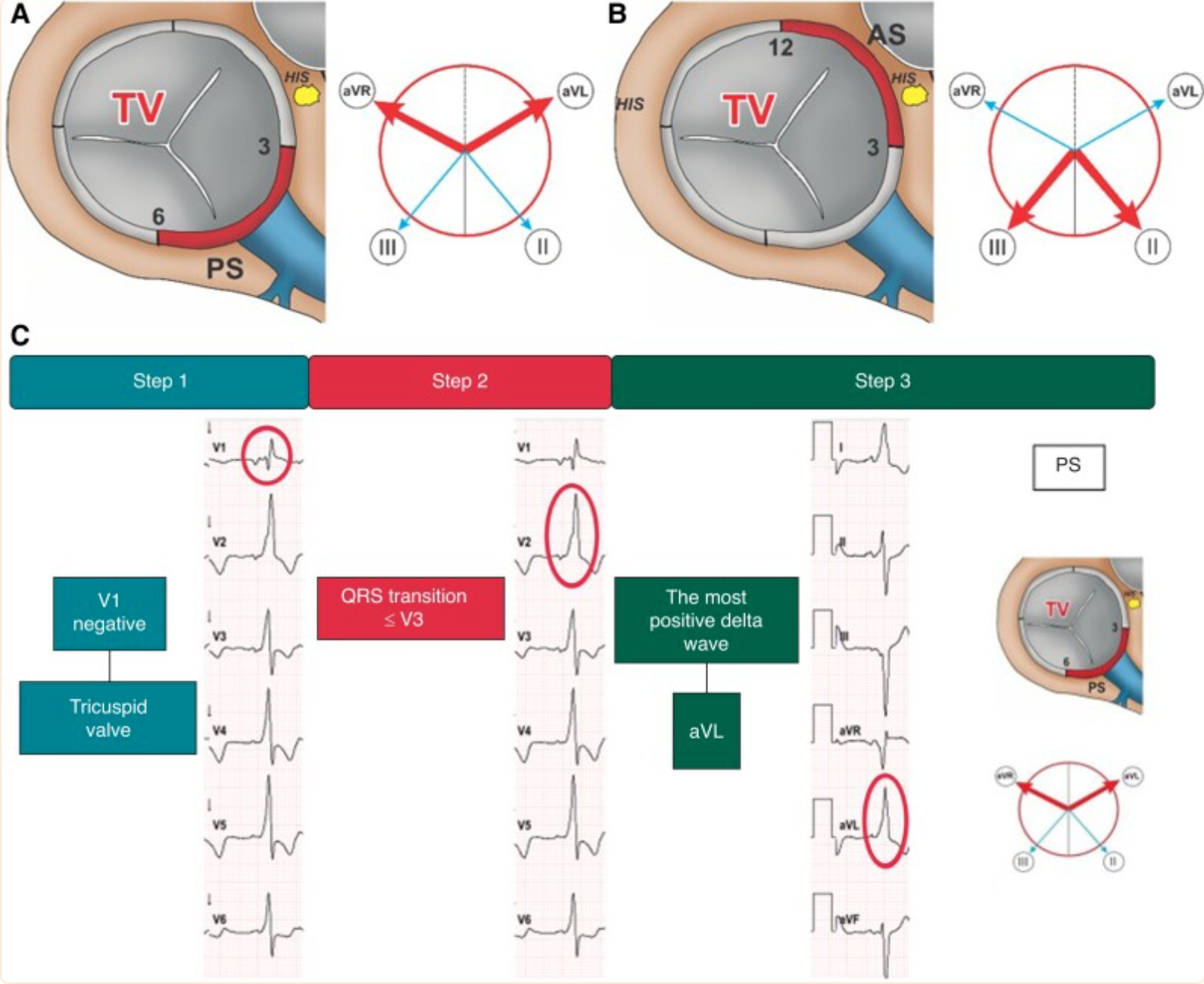 EASY-WPWとは? | 心電図.com