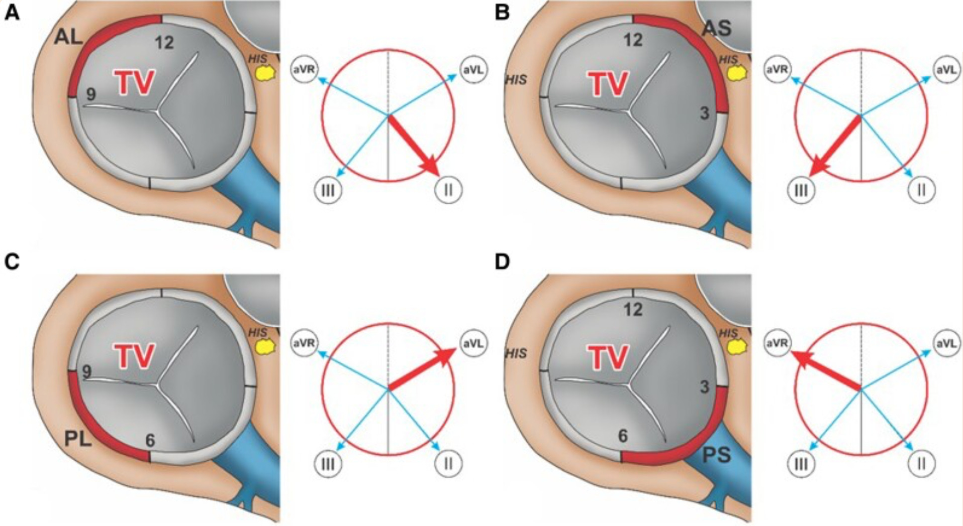EASY-WPWとは? | 心電図.com