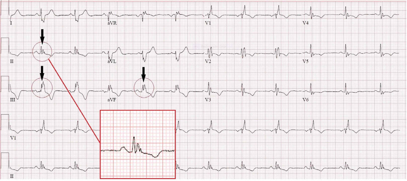 心房中隔欠損症とは? | 心電図.com