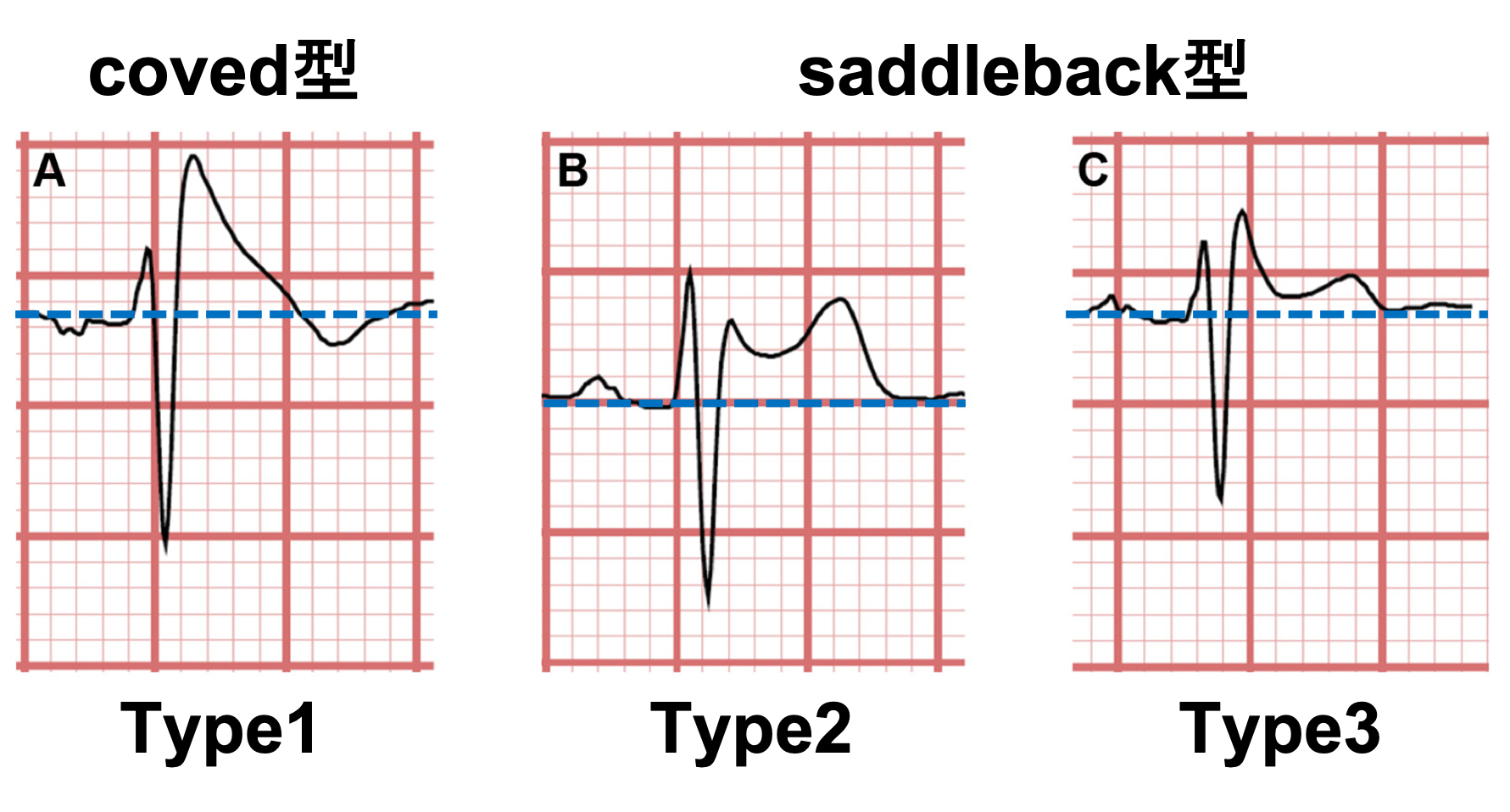 ブルガダ症候群とは？ | 心電図.com