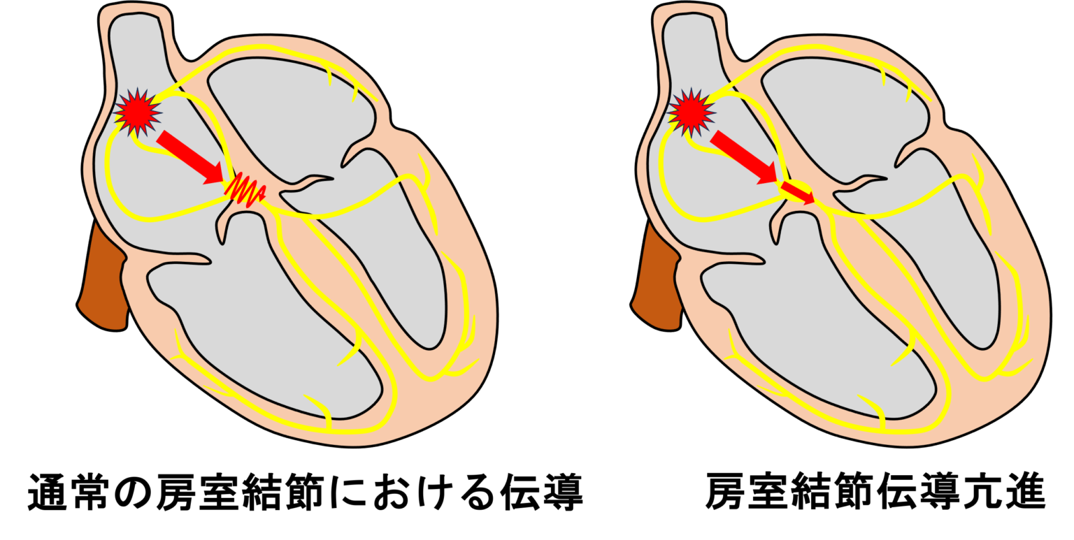 LGL症候群とは？ | 心電図.com