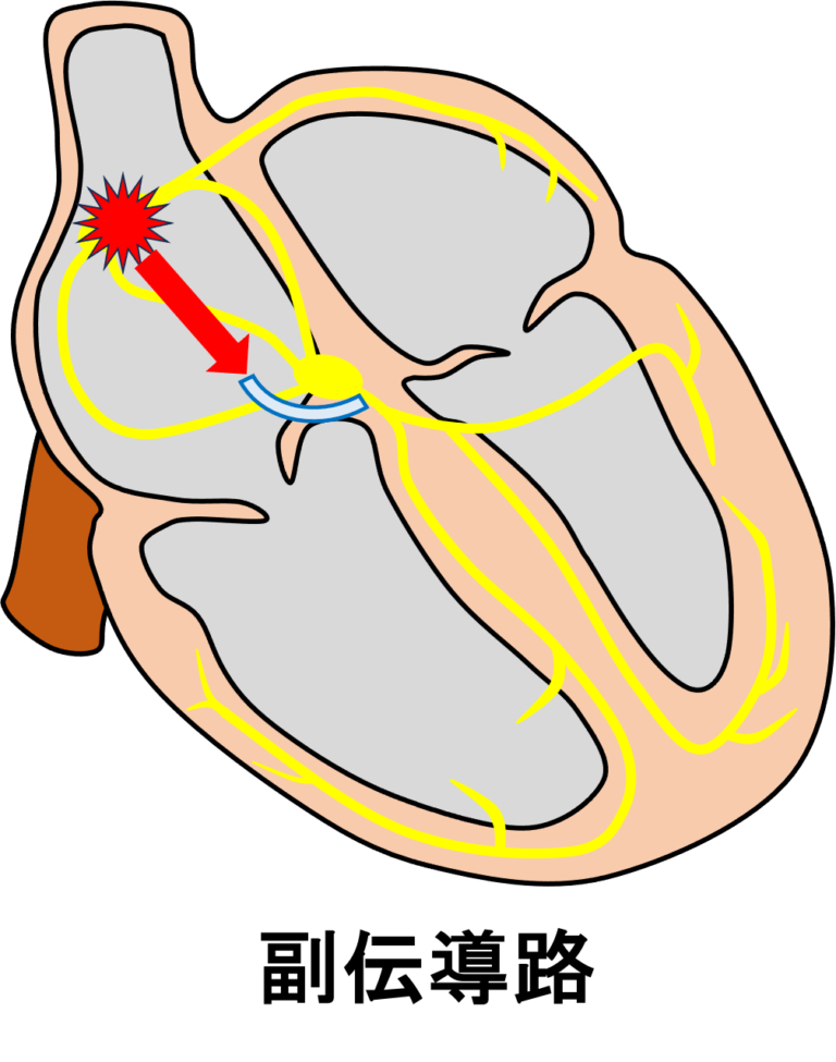 LGL症候群とは？ | 心電図.com