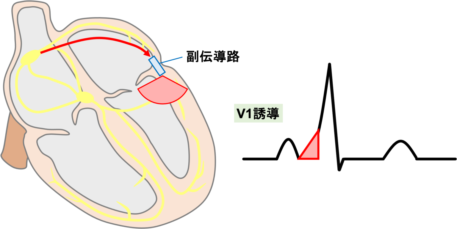 WPW症候群とは？ | 心電図.com