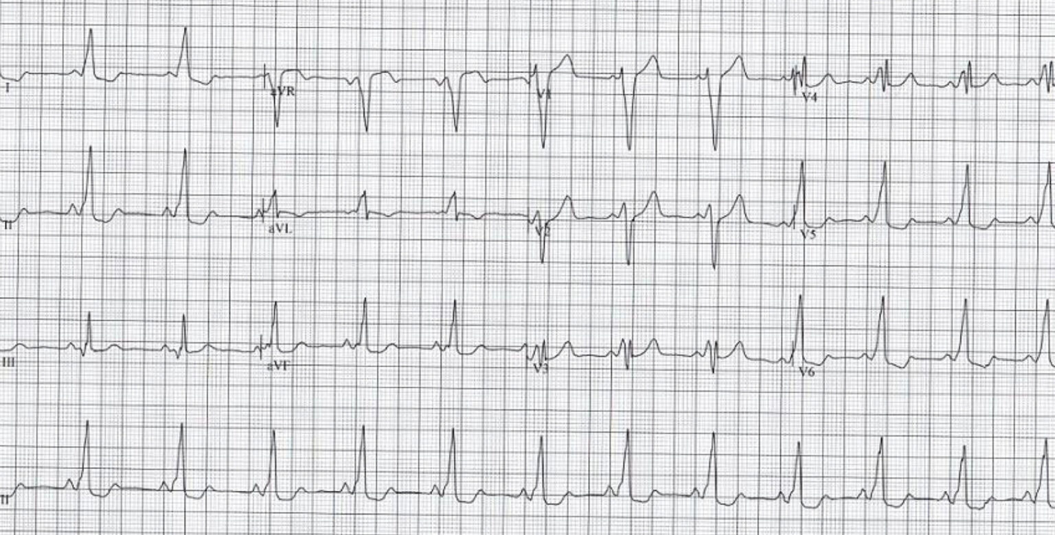 WPW症候群とは？ | 心電図.com