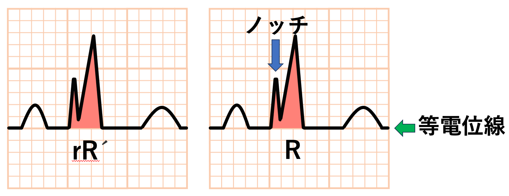 QRS波の命名法とは？ | 心電図.com