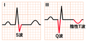 S1Q3T3 patternとは？ | 心電図.com