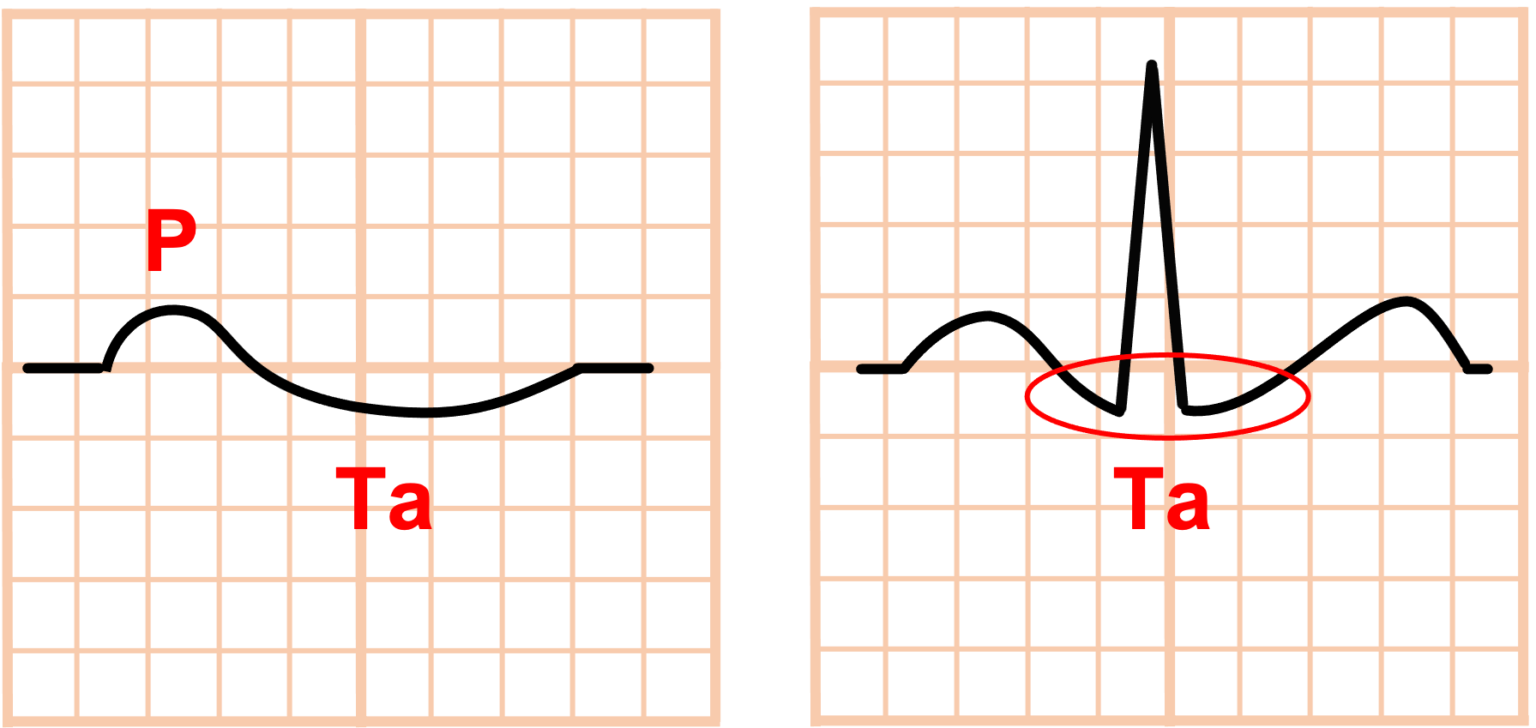 Ta波とは？ | 心電図.com