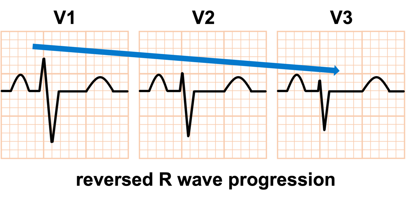 reversed R wave progressionとは？ | 心電図.com