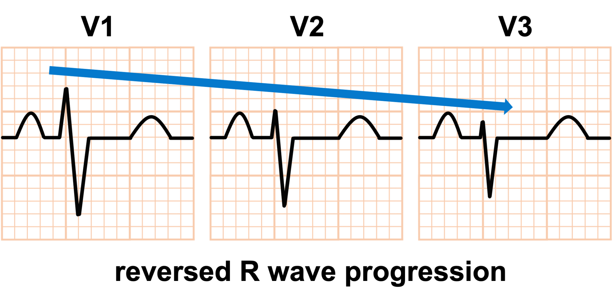 reversed R wave progressionとは？ | 心電図.com