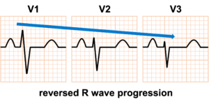 reversed R wave progressionとは？ | 心電図.com