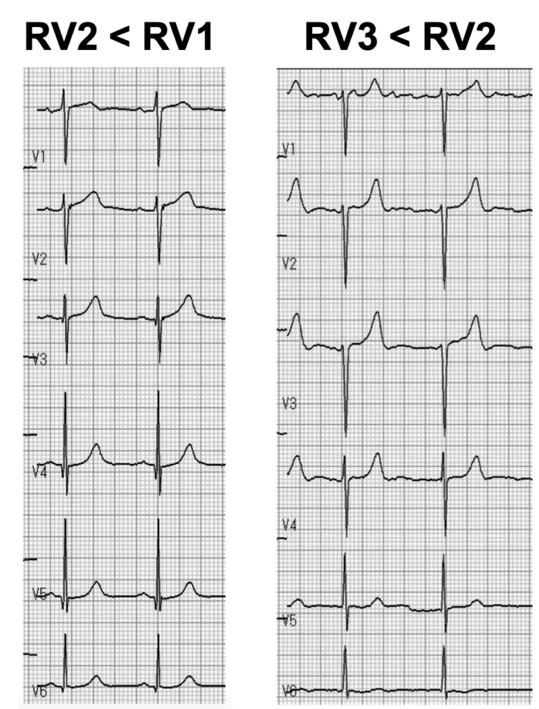reversed R wave progressionとは？ | 心電図.com