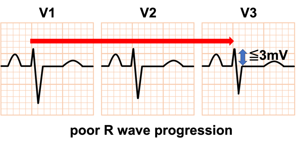 poor R wave progressionとは？ | 心電図.com