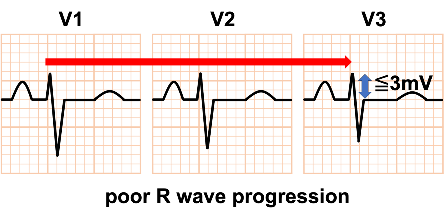 poor R wave progressionとは？ | 心電図.com