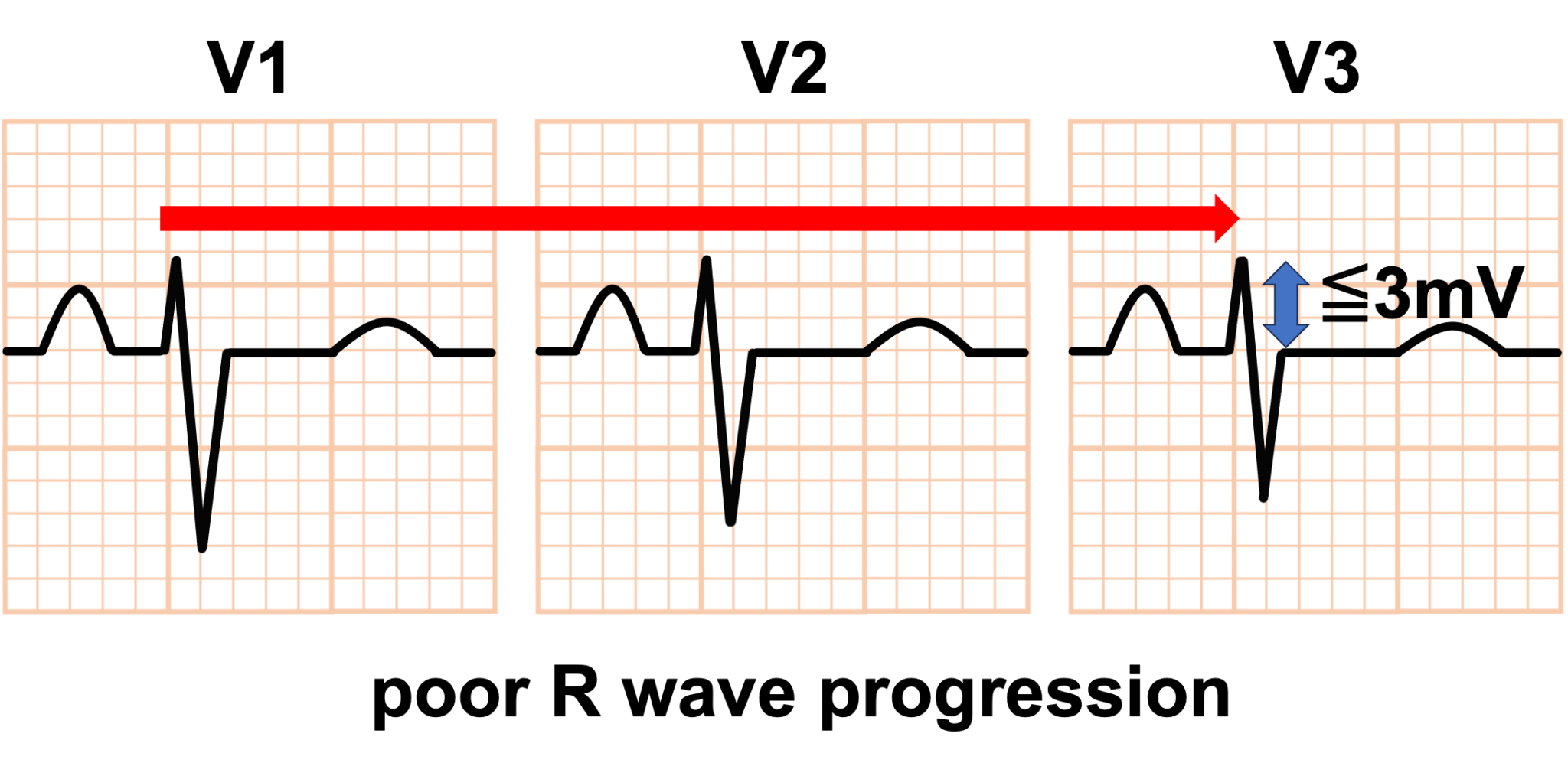poor R wave progressionとは？ | 心電図.com