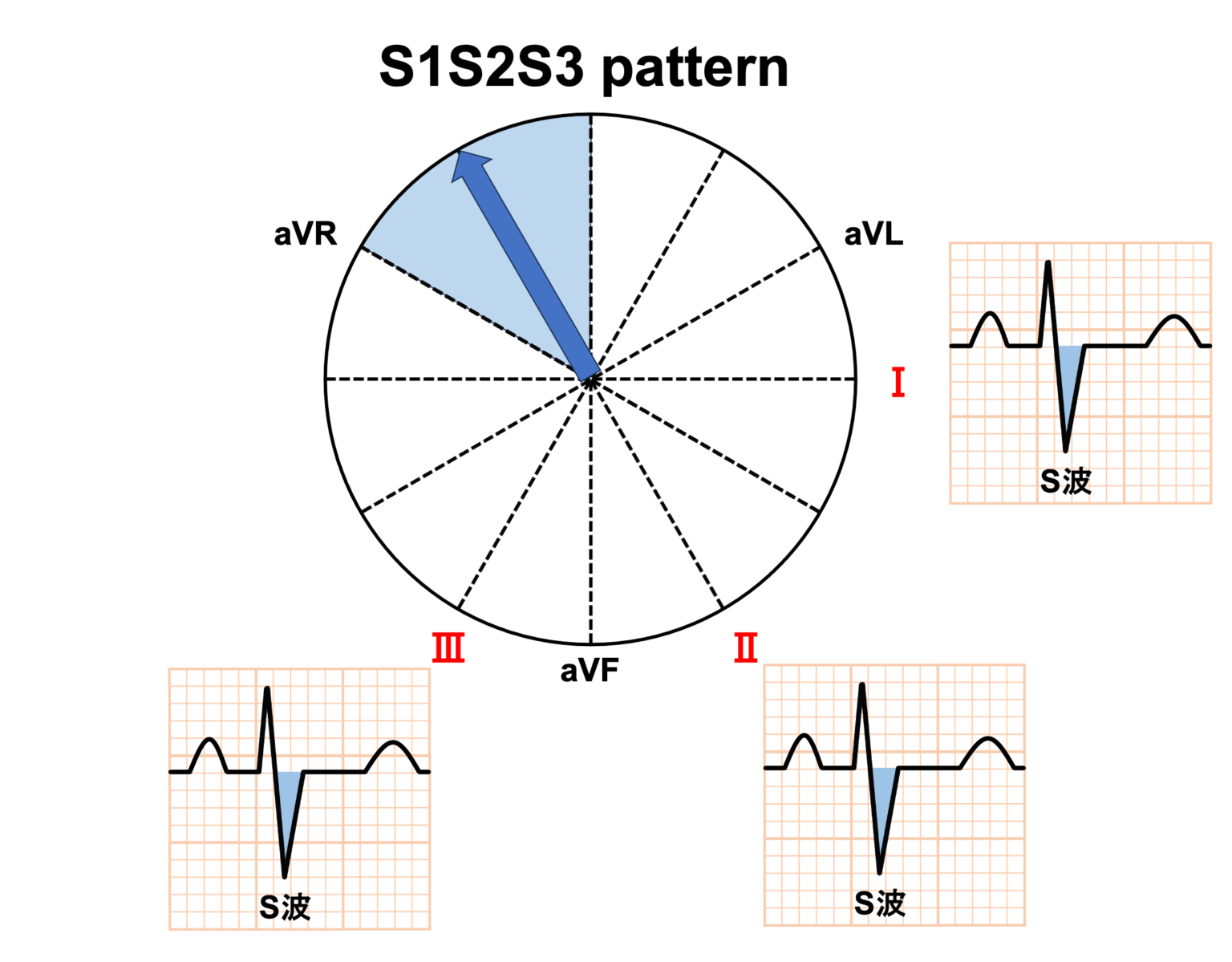 S1S2S3 patternとは？ | 心電図.com