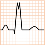 心房中隔欠損症とは? | 心電図.com