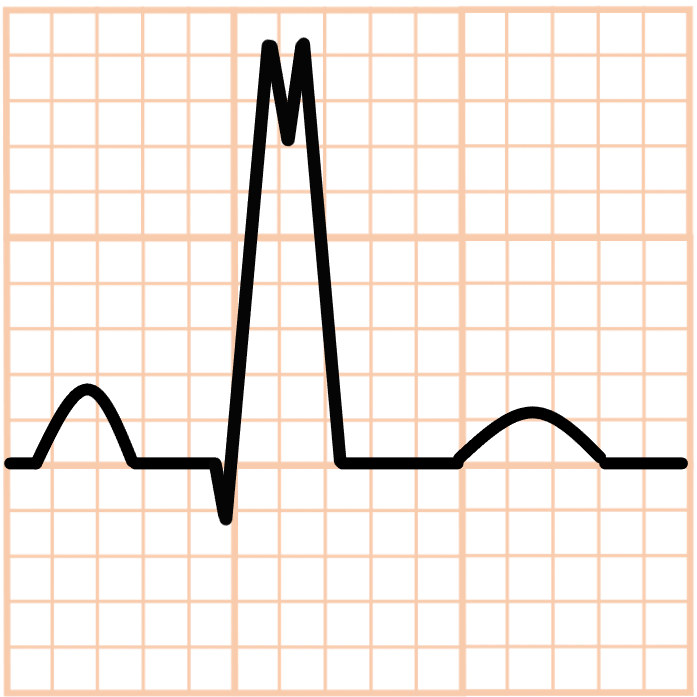 心房中隔欠損症とは? | 心電図.com