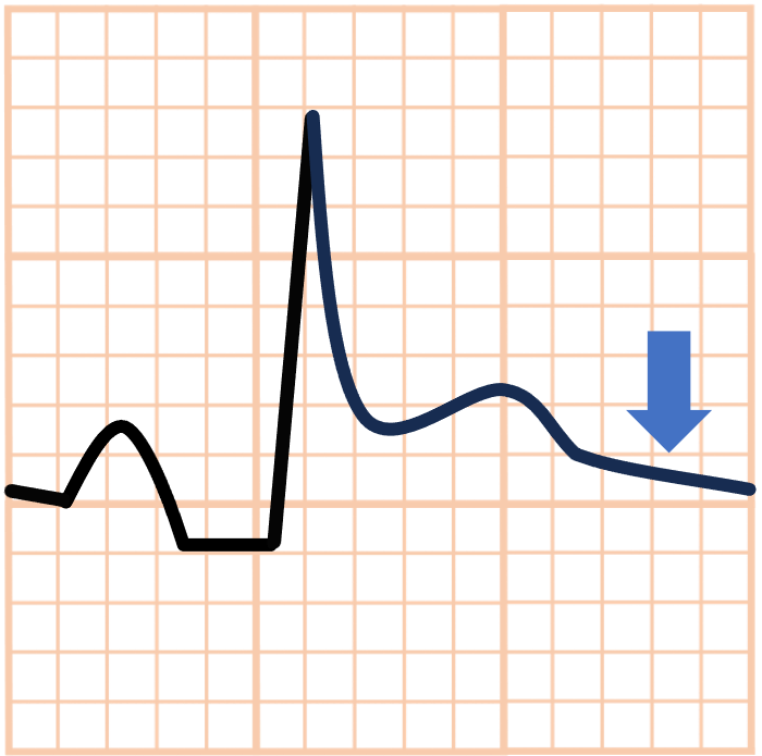 急性心膜炎とは？ | 心電図.com